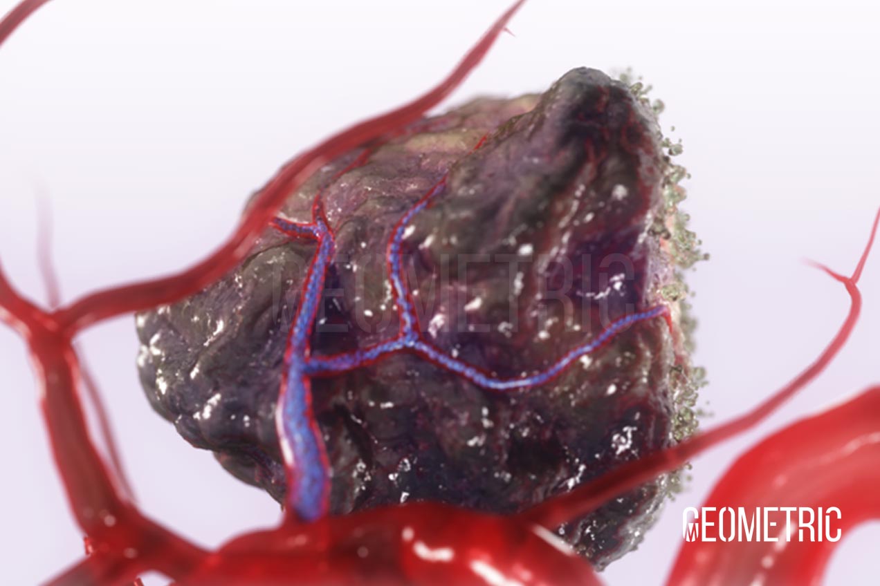 Chemoembolization | Embolization Animation | Geometric Medical